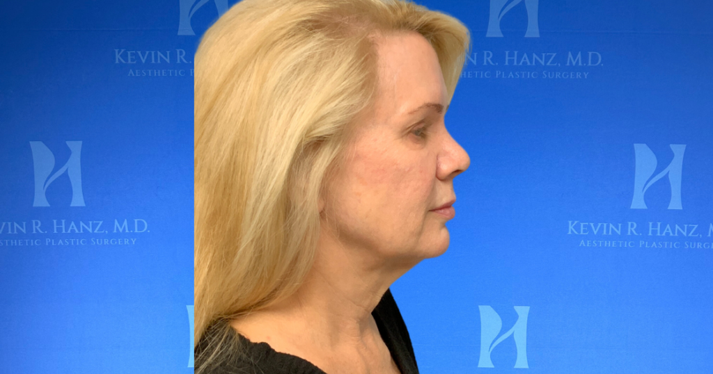 Face Lift #3 - Dr. Kevin Hanz