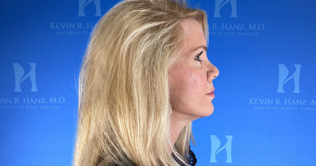 Face Lift #3 - Dr. Kevin Hanz