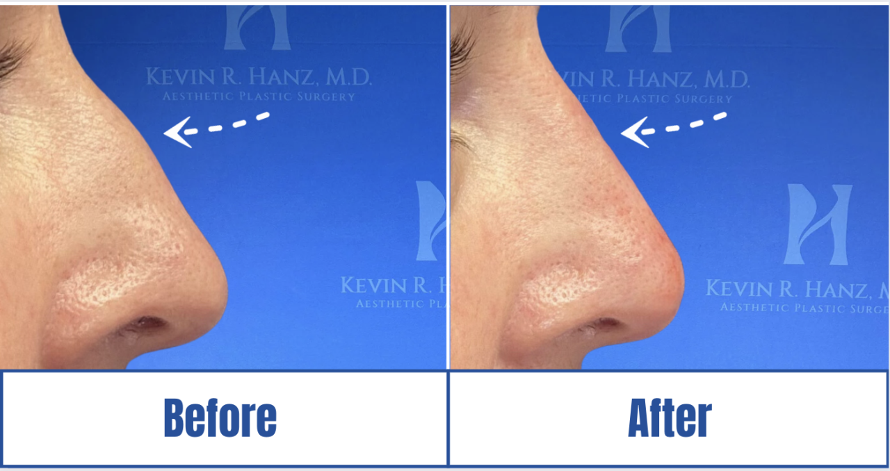 Filler Gallery - Dr. Kevin Hanz