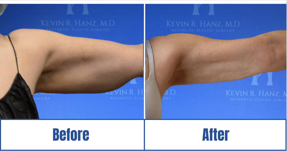 Liposuction: Arms - Dr. Kevin Hanz